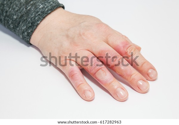 Mano en blanco con quemaduras de segundo grado en los dedos