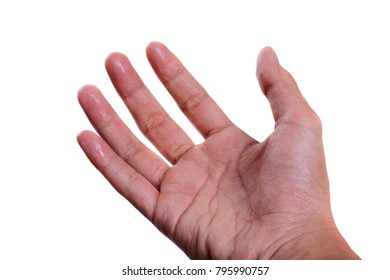 12 Hyperhidrosis wet hand from sweat syndrome Images, Stock Photos ...
