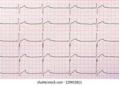 Heart Rhythm Chart Background Usage Stock Photo 129852821 | Shutterstock
