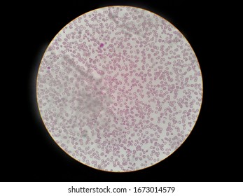 Thalassemia Hbe Peripheral Blood Smear Contain Stock Photo 1462556438 ...