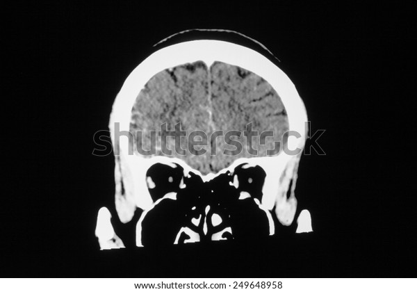 Hemorrhagic Stroke Ct Scan Computed Tomography Stock Photo 249648958 ...