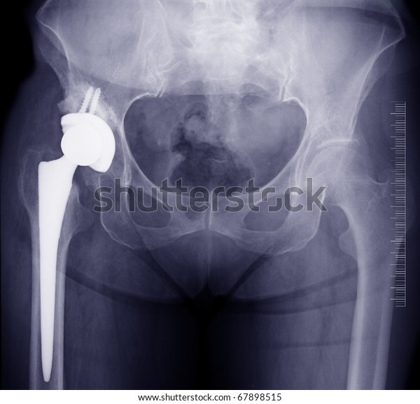 Hip Replacement Xray Stock Photo (Edit Now) 67898515
