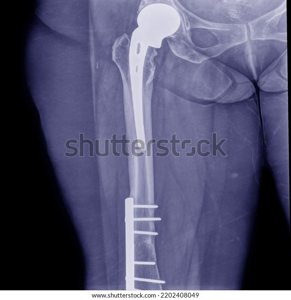 Hip Thigh Xrays Hip Thigh Splints Stock Photo 2202408049 | Shutterstock