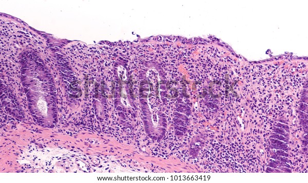 Histologic Section Biopsy Obtained During Colonoscopy Stock Photo (Edit ...