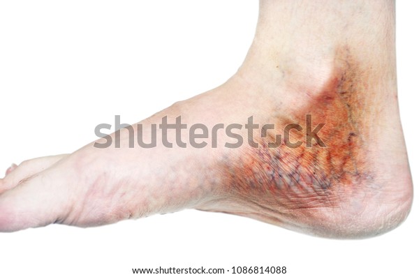 Human Leg Blocked Veins Thrombosis Phlebitis Foto Stok 1086814088 Shutterstock