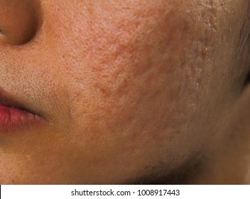 Human Problems Holes On Rough Face Foto Stok 1008917443 | Shutterstock