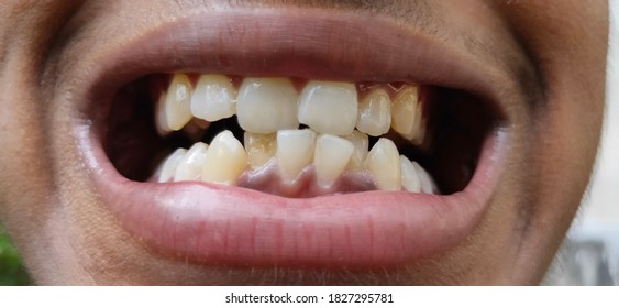 Human Teeth Lips Reference Dental Study Stock Photo 1827295781 ...