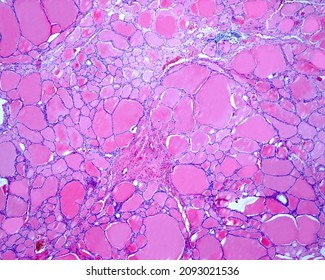 Human Thyroid Gland Case Diffuse Goiter Stock Photo 2093021536 ...