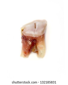 Human Tooth Pulled Stock Photo (Edit Now) 132185834