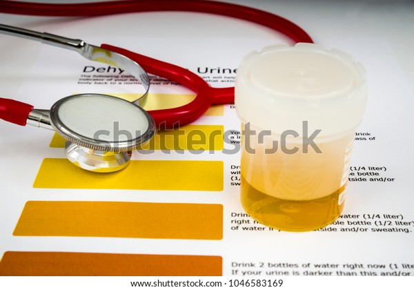 Human Urine SampleHuman urine sample waiting for testing, with a ...