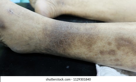Lipodermatosclerosis Images, Stock Photos & Vectors | Shutterstock