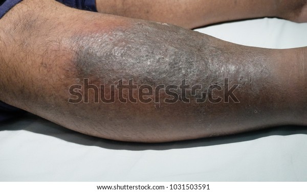 Hyperpigmentation Skin Cellulitis Lower Limb Patient Stock Photo (Edit ...
