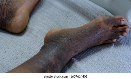 Hyperpigmented Lower Limb Lipodermatosclerosis Varicose Vein Foto de ...