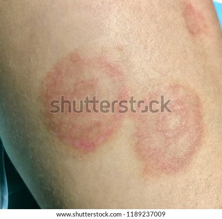 TARGET-LIKE-LESION Stock Photos and Images - Avopix.com