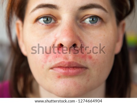WOMAN-FACE-WITH-ATOPIC-DERMATITIS Stock Photos and Images - Avopix.com