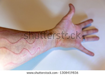 DERMATOGRAPHIC-URTICARIA Stock Photos and Images - Avopix.com