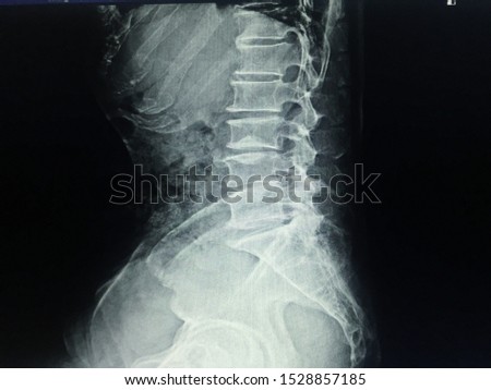 PELVIC-SPURS Stock Photos and Images - Avopix.com
