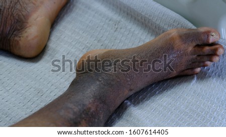 LIPODERMATOSCLEROSIS Stock Photos and Images - Avopix.com