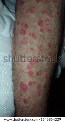 TARGET-LIKE-LESION Stock Photos and Images - Avopix.com