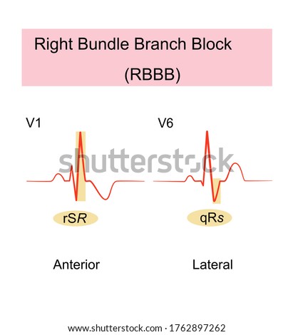 RIGHT-BUNDLE-BRANCH-BLOCK Stock Vector Images - Avopix.com
