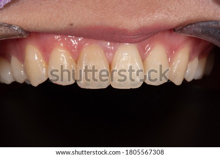ANTERIOR-TEETH Stock Photos and Images - Avopix.com