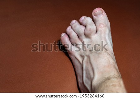 GOUTY-TOES Stock Photos and Images - Avopix.com