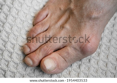 GOUTY-TOES Stock Photos and Images - Avopix.com