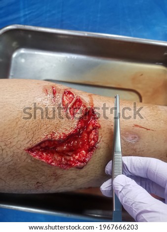 DEEP-LACERATION-WOUND Stock Photos and Images - Avopix.com