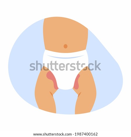 DIAPER-RASH Stock Vector Images - Avopix.com
