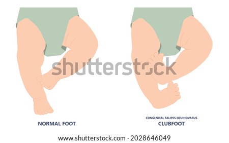 ARTHROGRYPOSIS-CONGENITAL Stock Vector Images - Avopix.com