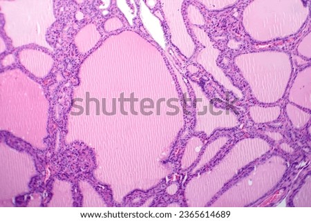 COLLOID-GOITER Stock Photos and Images - Avopix.com