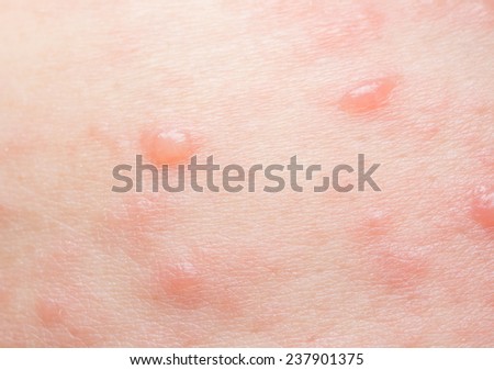 VESICULAR-RASH-REACTION-FROM-DRUG-ALLERGY Stock Photos and Images ...