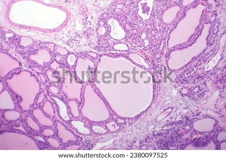 COLLOID-GOITER Stock Photos and Images - Avopix.com