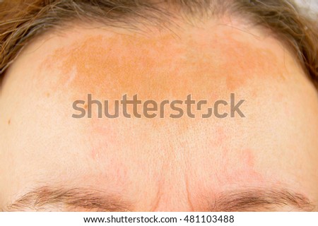 WOMAN-FACE-WITH-ATOPIC-DERMATITIS Stock Photos and Images - Avopix.com