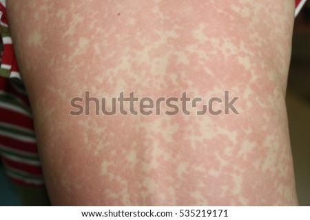 MEASLES-RASH Stock Photos and Images - Avopix.com