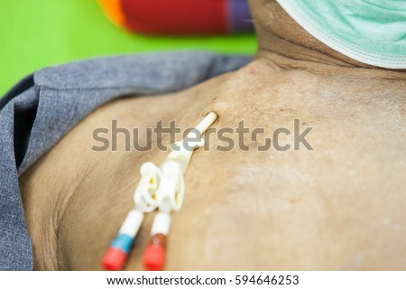 PERMANENT-CATHETER-FOR-DIALYSIS Stock Photos and Images - Avopix.com