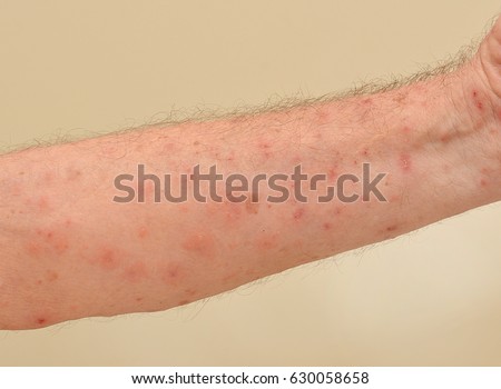 SCABIES Stock Photos and Images - Avopix.com