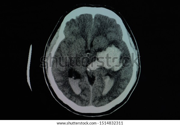 Image of a CT brain scan of a Stroke patient with severe headache ...