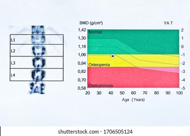 58 Dexa scan Images, Stock Photos & Vectors | Shutterstock