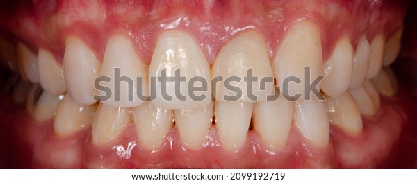 Improper Uneven Size Front Teeth Missing Stock Photo 2099192719 ...