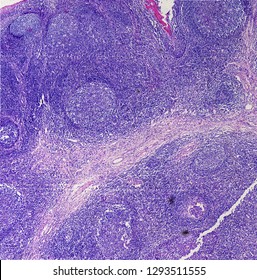 Inflammation Human Tonsils Tonsillitis Section Under Stock Photo ...
