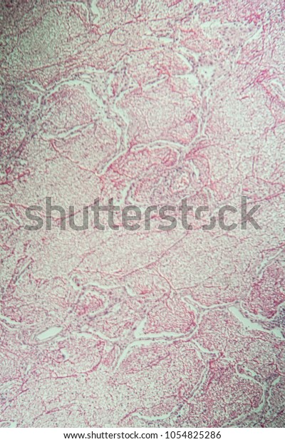 Inflammation Inflamed Tissue Under Microscope Stock Photo 1054825286 ...