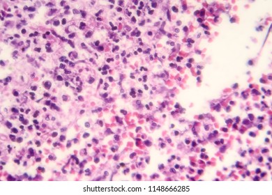 Inflammation Light Micrograph Showing Different Inflammatory Stock ...
