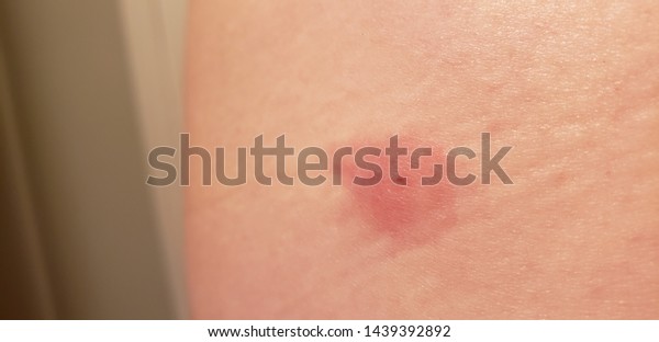 Insect Bite On Light Colored Skin Stock Photo (Edit Now) 1439392892