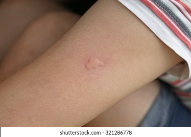81,828 Insect bites Images, Stock Photos & Vectors | Shutterstock