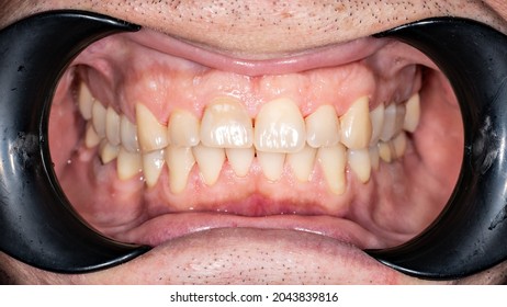 41 Lip retraction Images, Stock Photos & Vectors | Shutterstock