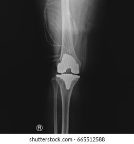 Xray After Right Total Knee Replacement Stock Photo 738701860 ...