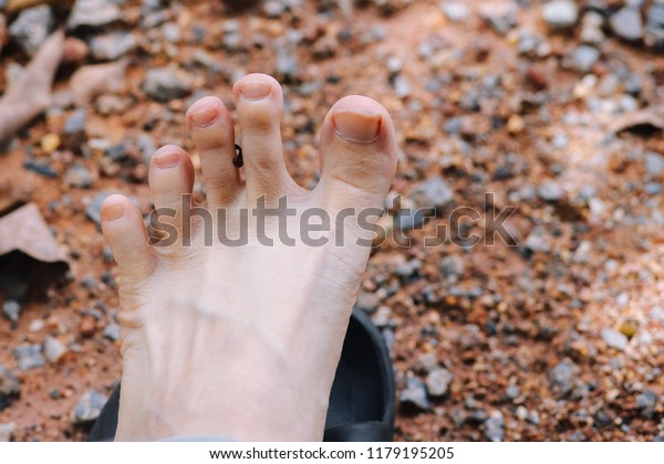 Leech Bite Toe During Walking Rainforest Stock Photo (Edit Now) 1179195205