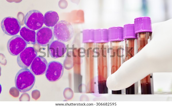 Leukemia Cells Scienctist Testing Laboratory Stock Photo (Edit Now ...