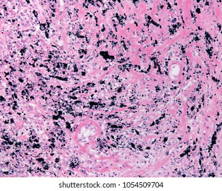 Anthracotic pigment : 13 images, photos et images vectorielles de stock ...